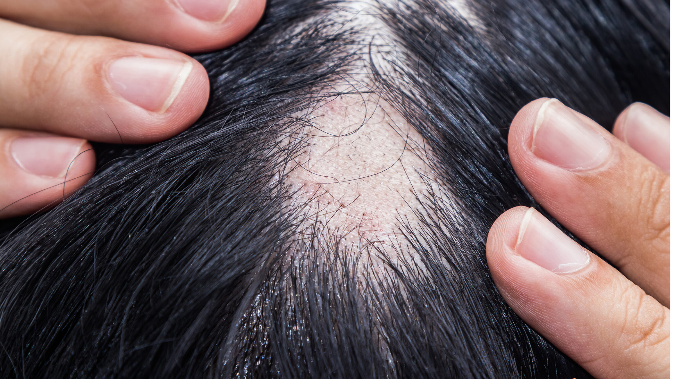 Embracing Change Confidence and Acceptance in the Face of Hair Loss ...